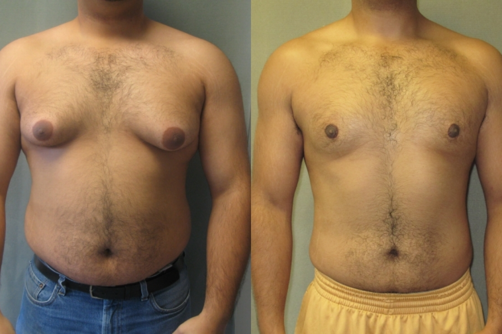 Understanding Gynecomastia in Dubai: A Guide to Treatment and Solutions